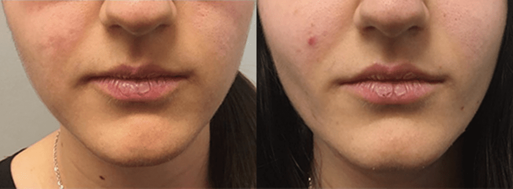 Buccal Fat Pad - Dr Ahmed Alsayed